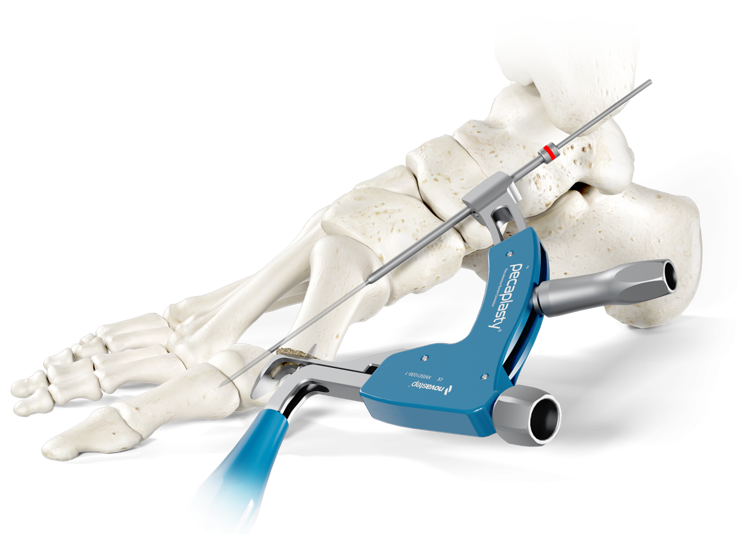 Pecaplasty – Medline UAE