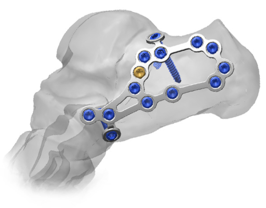 Calcaneus Plate – Medline UAE