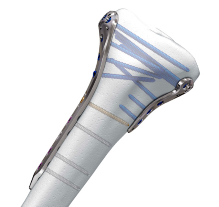 Proximal Tibia Plate – Medline UAE